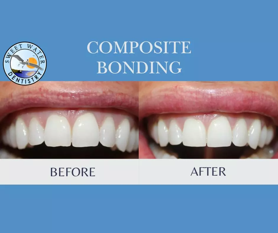 Composite Bonding for a Chipped Front Tooth | Dentist in Fairhope, AL 36532
