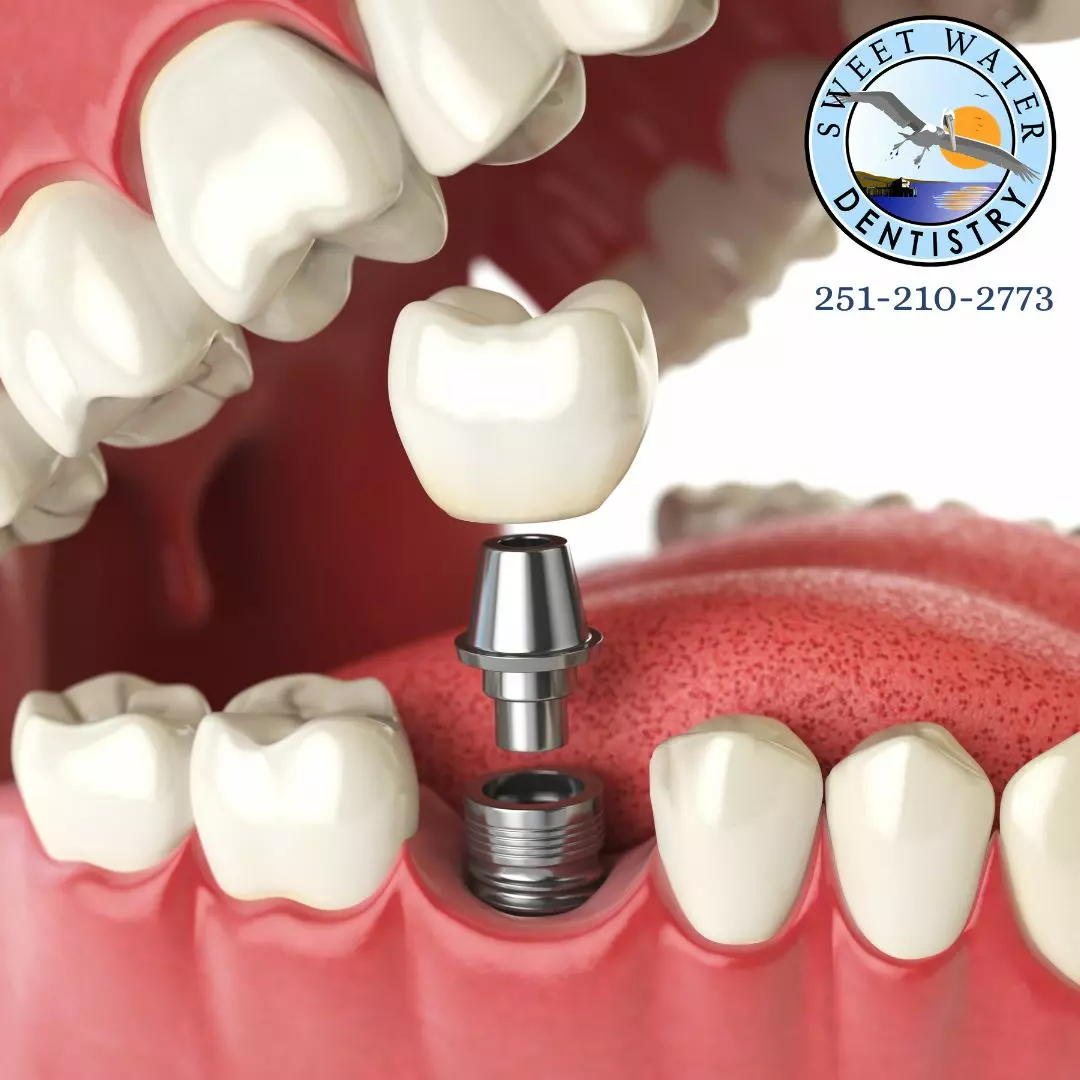 Do You Get Temporary Teeth While Waiting For Implants? | Dentist in ...